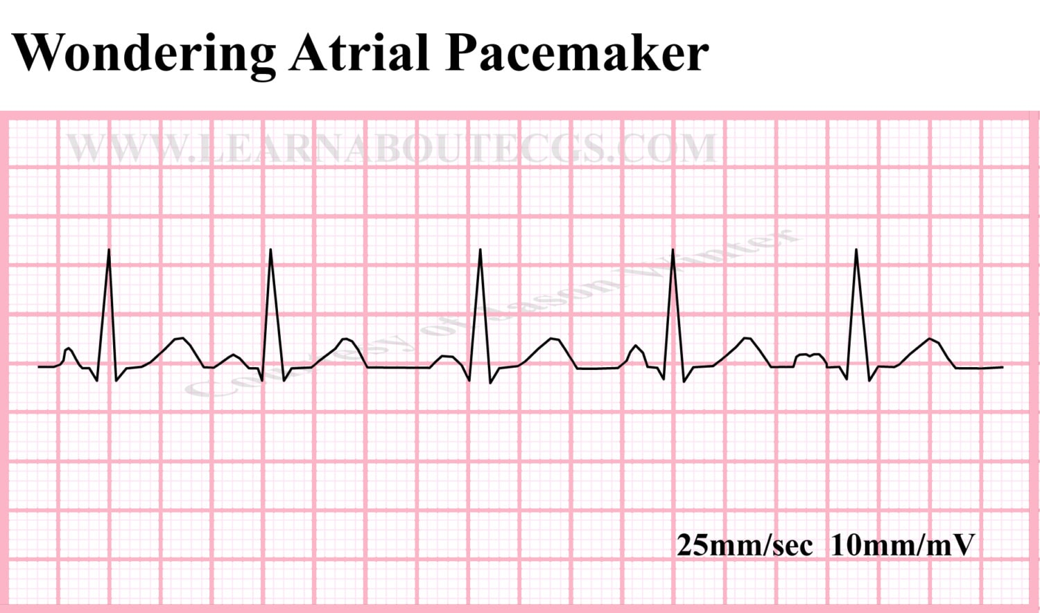 Wondering Atrial Pacemaker WAP ECG Strip by ELECTROCARDIOLOGY
