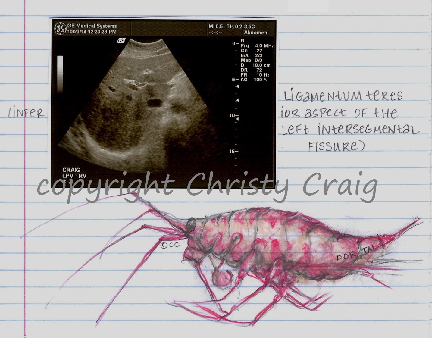 Shrimp Portal Vein Print