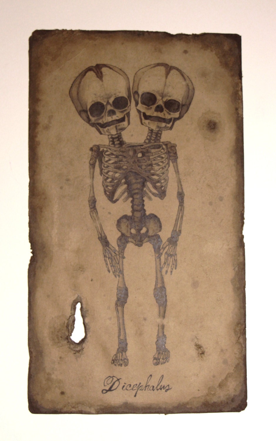 Conjoined twins skeleton Original drawing Medical by DrZierbo