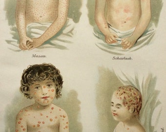 Measles | Etsy