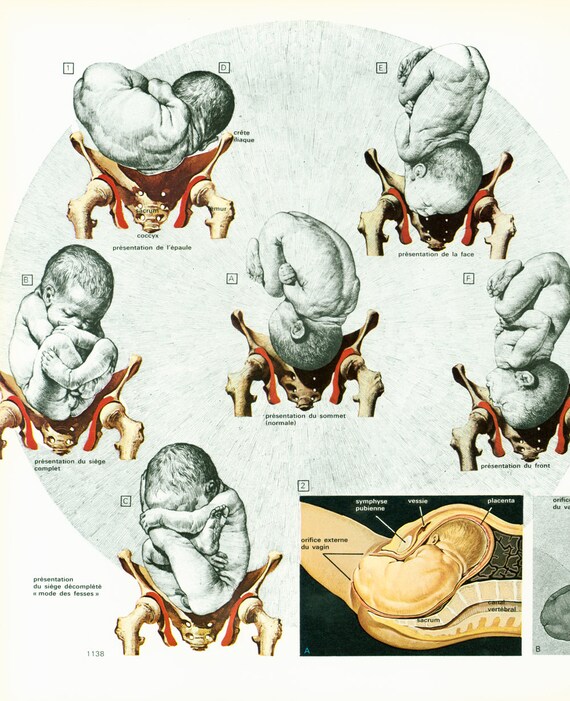 1975 Accouchement présentation du foetus siège par sofrenchvintage