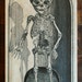 Conjoined twins skeleton Original drawing Medical by DrZierbo