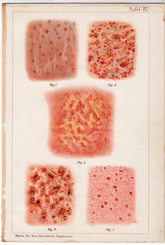 c. 1902 SKIN DISEASE PRINT syphilid syphilis infections
